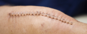 Scar Mobilization Frisco & Prosper, TX | Therapy Fit Physical Therapy